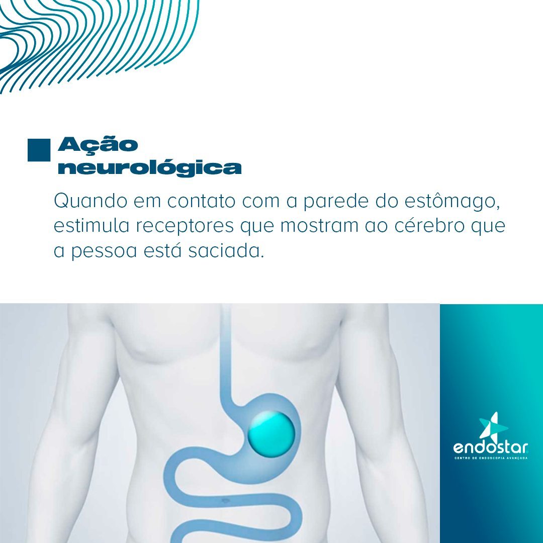 Como o balão intragástrico age no meu estômago? - Bem Star Bem - Endostar